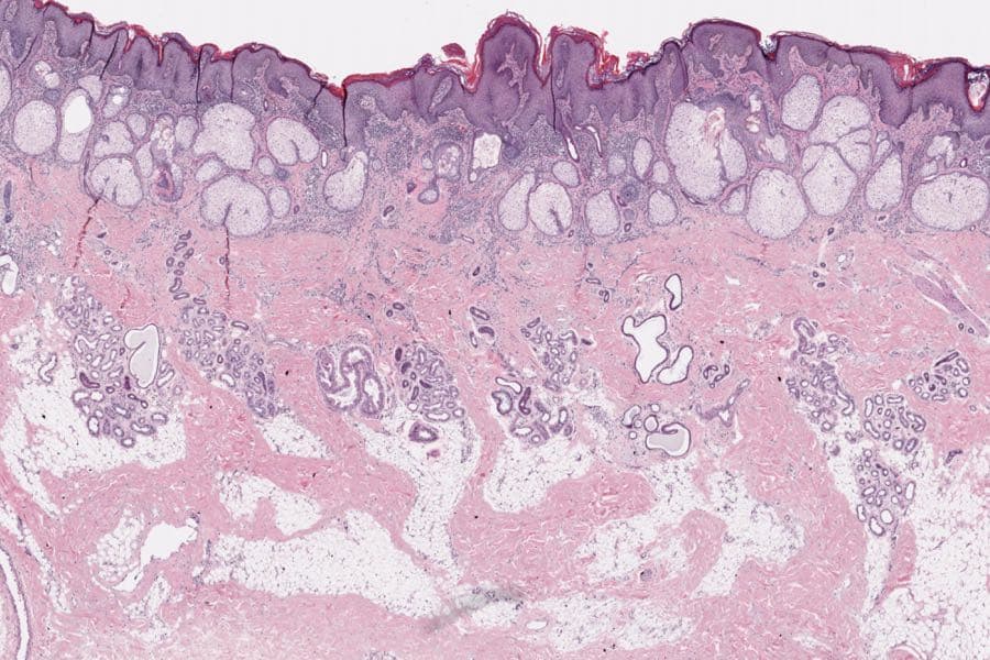 Intradermal Nevus Whole Slide Image Viewer-uScopeMXII 40x (0.65NA ...